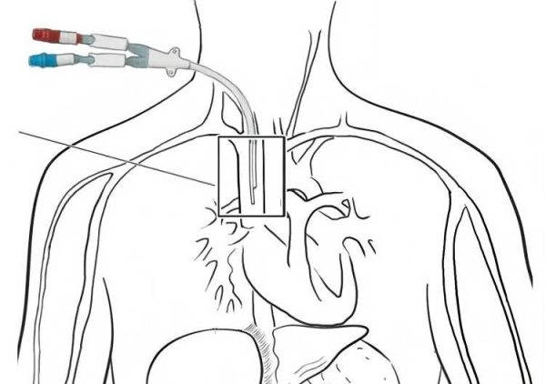 Understanding IV Catheter Types: A Complete Guide for Healthcare ...
